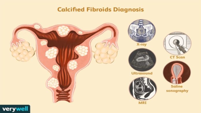 Signs of Fibroids Breaking Down You Should Know | Densipaper